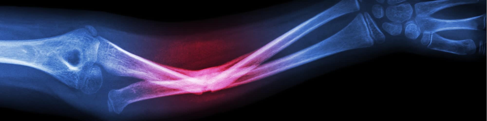 Bone Fractures and Dislocations Care | OrthoUnited