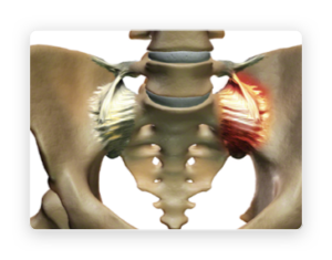 Minimally Invasive Sacroiliac Joint (SI) Surgery | OrthoUnited