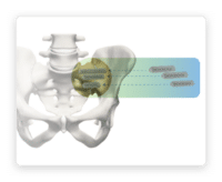 Minimally Invasive Sacroiliac Joint (SI) Surgery | OrthoUnited