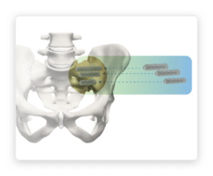 Minimally Invasive Sacroiliac Joint (SI) Surgery | OrthoUnited