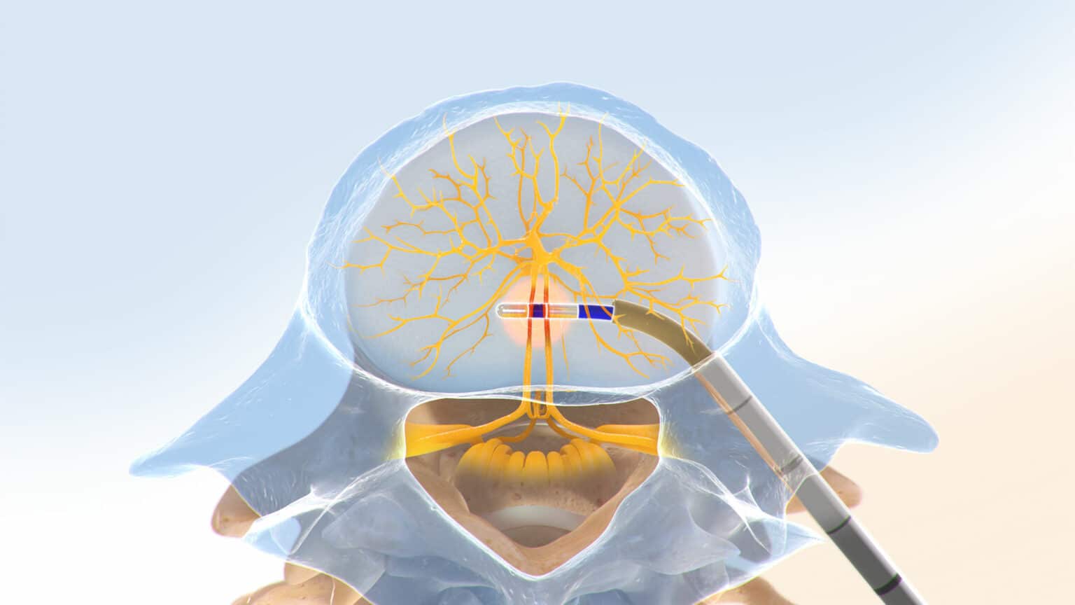 Explore the Intracept Procedure for Chronic Low Back Pain