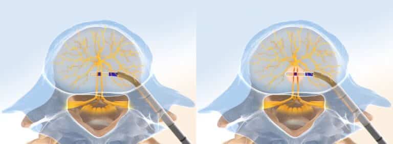 Intracept Procedure for Chronic Low Back Pain | OrthoUnited